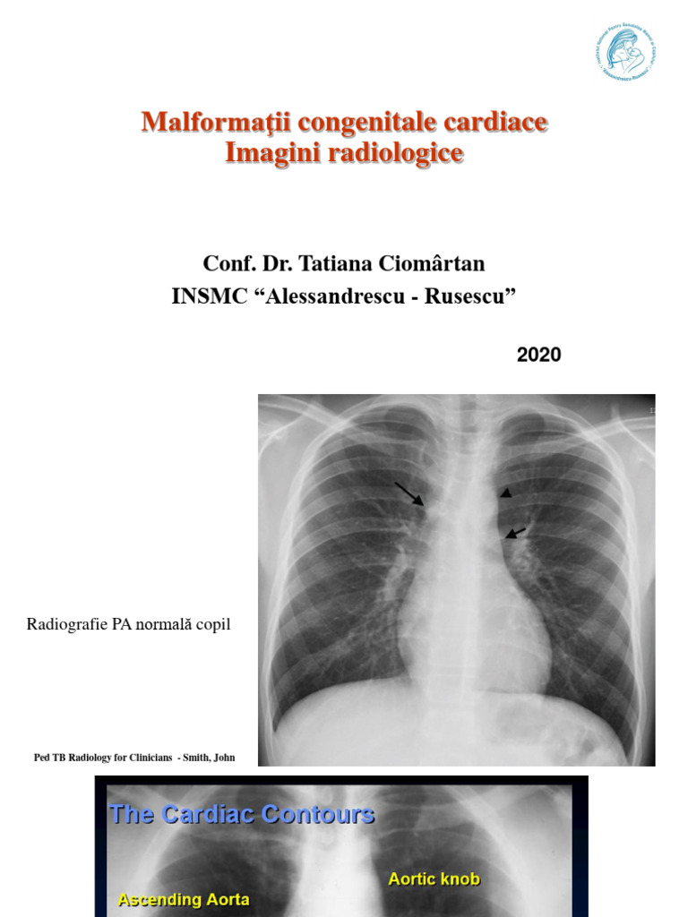 Malformaţii Congenitale Cardiace - Imagini Radiologice 2020 PDF | PDF