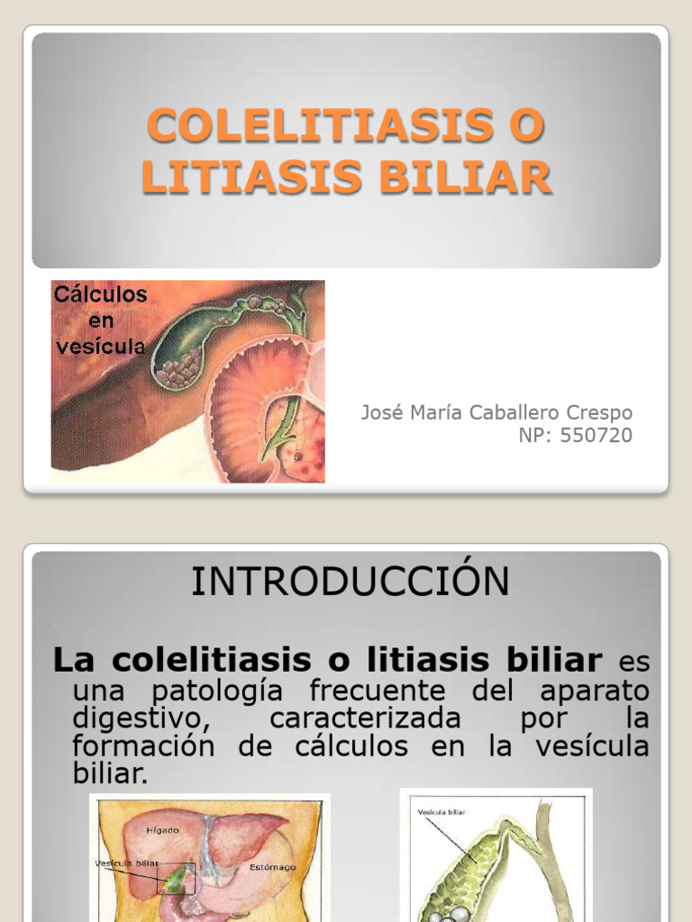 colelitiasis-130513164356-phpapp01 | PDF