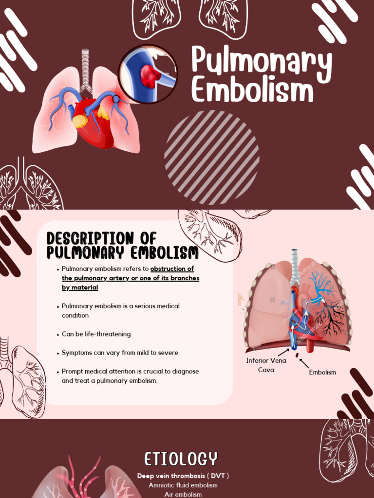 Pulmonary Embolism | PDF
