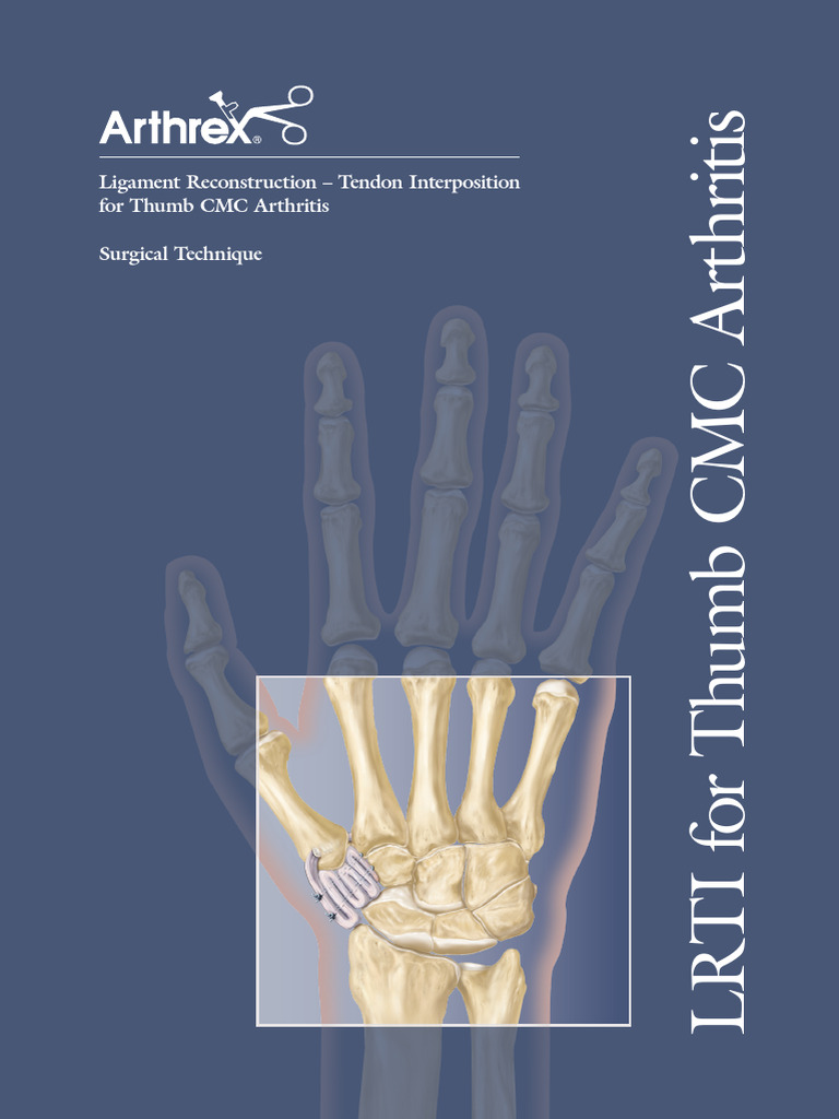 Ligament Reconstruction Tendon Interposition For Thumb CMC Arthritis ...