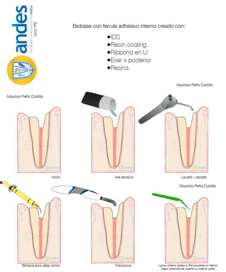 Ribbond y Ever X Posterior | PDF