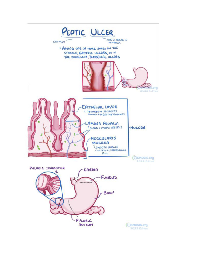 Osmosis Peptic Ulcer | PDF