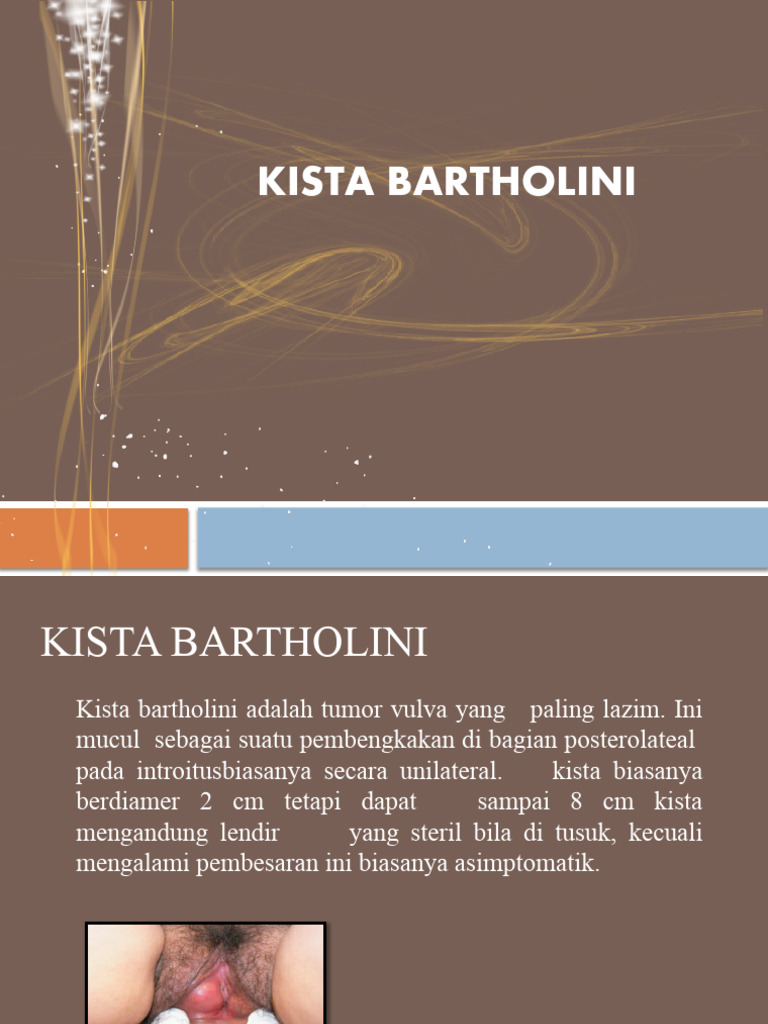 Kista Bartolin -Dila r. | PDF