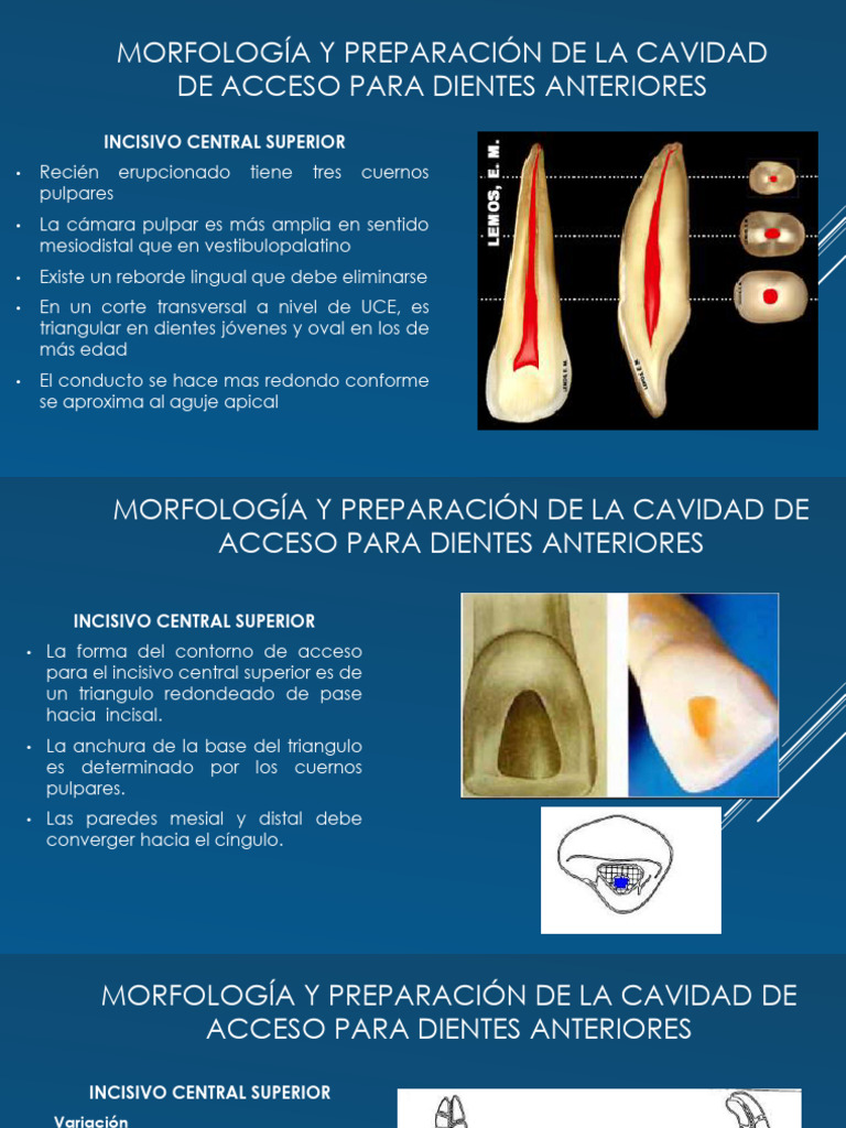 Acceso Endodóntico Incisivos Superiores Pdf