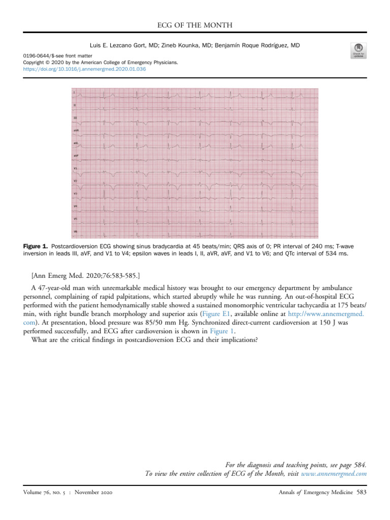 Epsilon Wave | PDF | Electrocardiography | Cardiology
