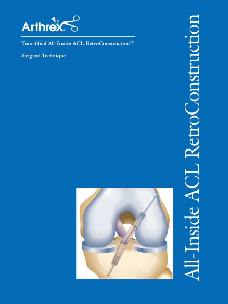 Transtibial All Inside Acl Retroconstruction | PDF