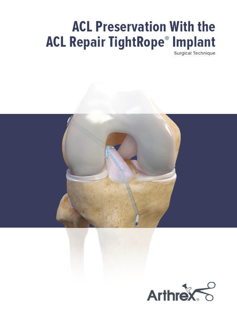 Acl Preservation With The Acl Repair Tightrope Implant | PDF | Knee ...