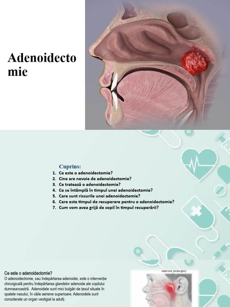 Adenoidectomie ORL | PDF