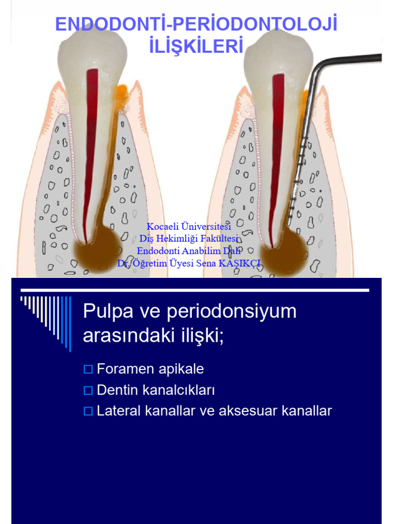 Endo-Perio Ili Kisi | PDF