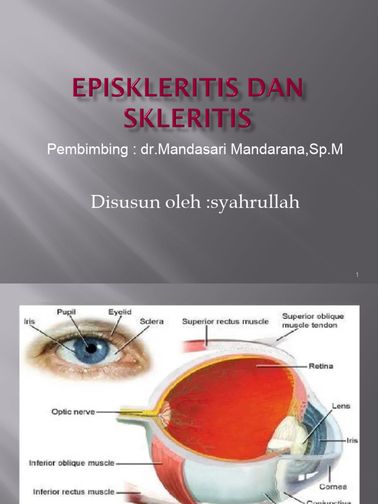 Episkleritis Dan Skleritiss PPT | PDF