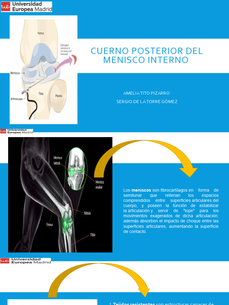 Inflacion de Cuerno Posterior Del Menisco Interno | PDF