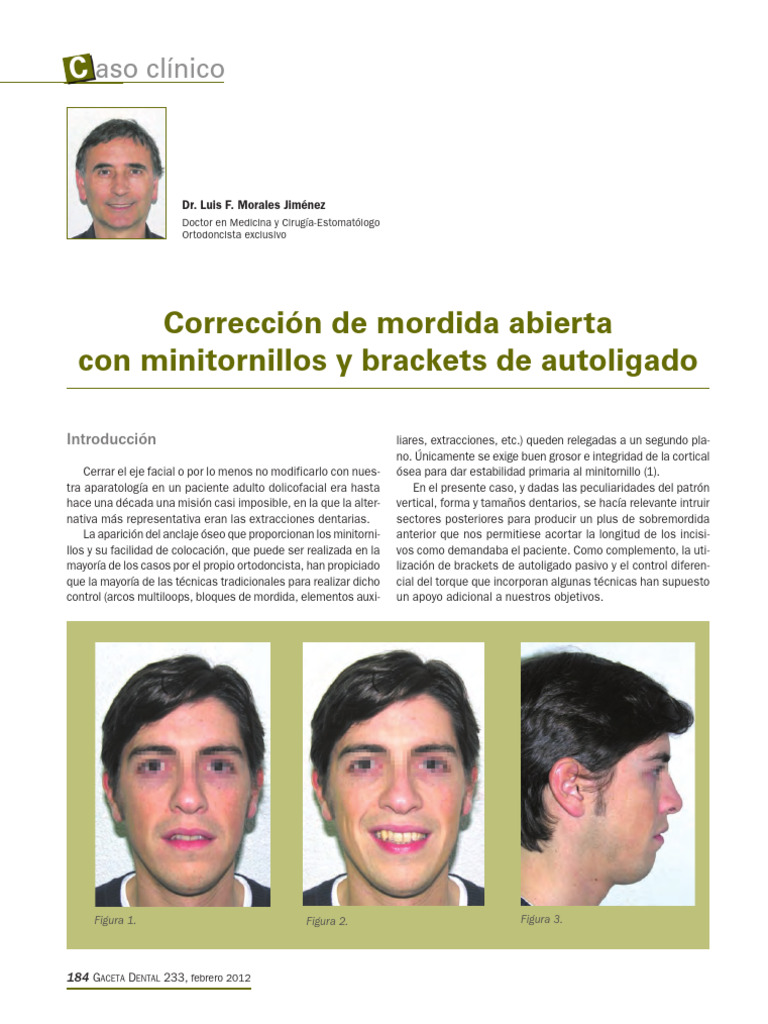 233 CASO CLINICO Correccion Mordida Microtornillos | PDF