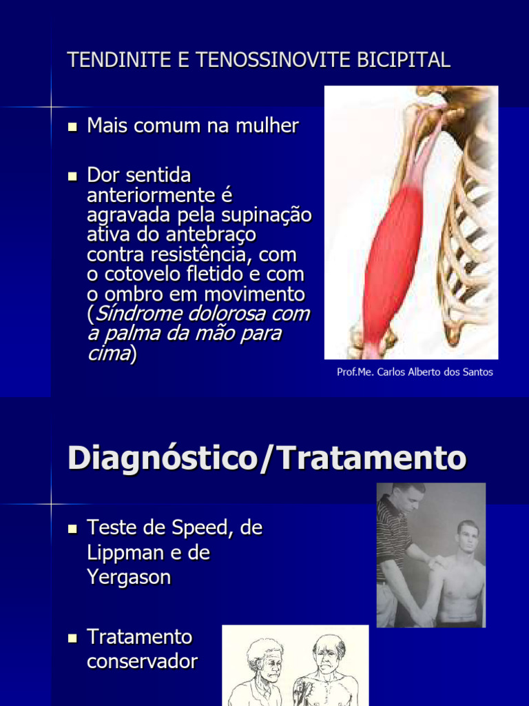 Tratamento da Tendinite Bicipital | PDF