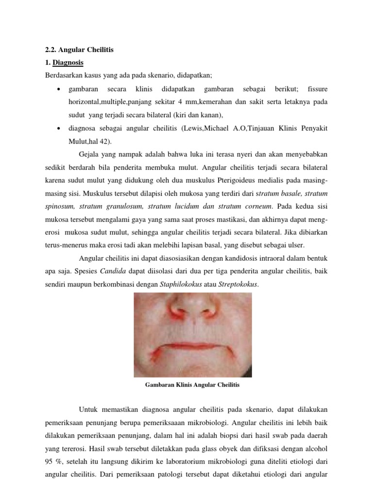 Angular Cheilitis Words | PDF