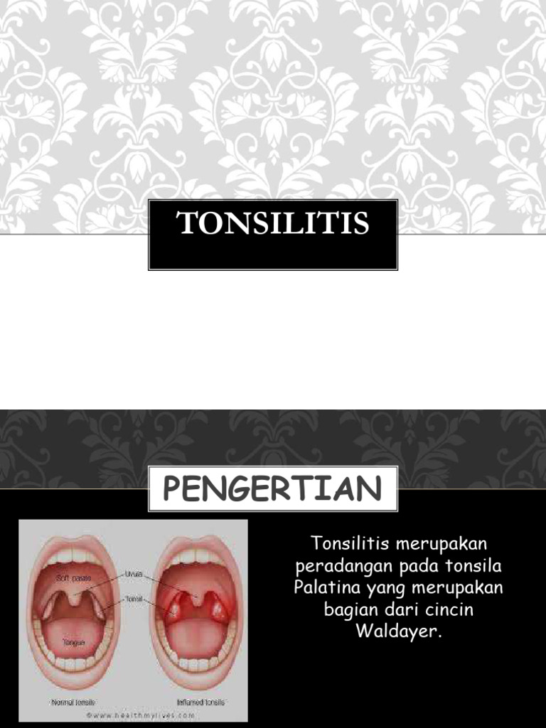 Tonsilitis | PDF | Sains & Matematika