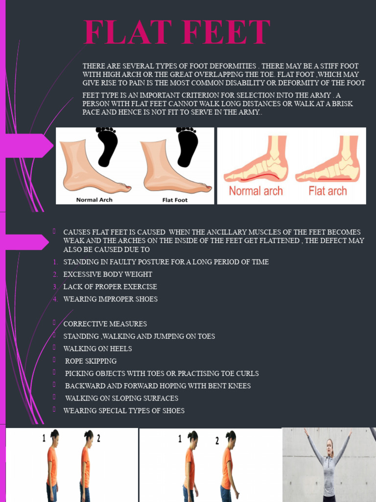 Flat Feet | PDF