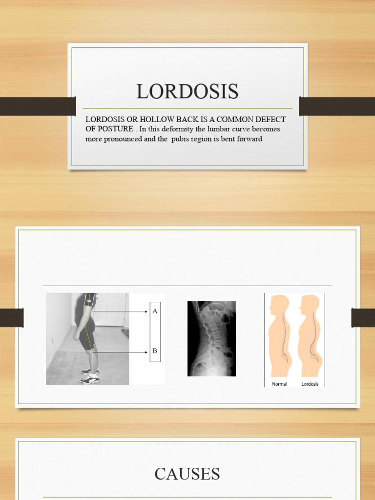Lordosis | PDF