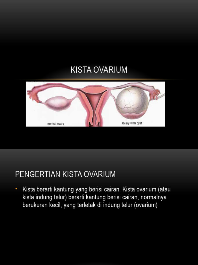 Kista Ovarium | PDF