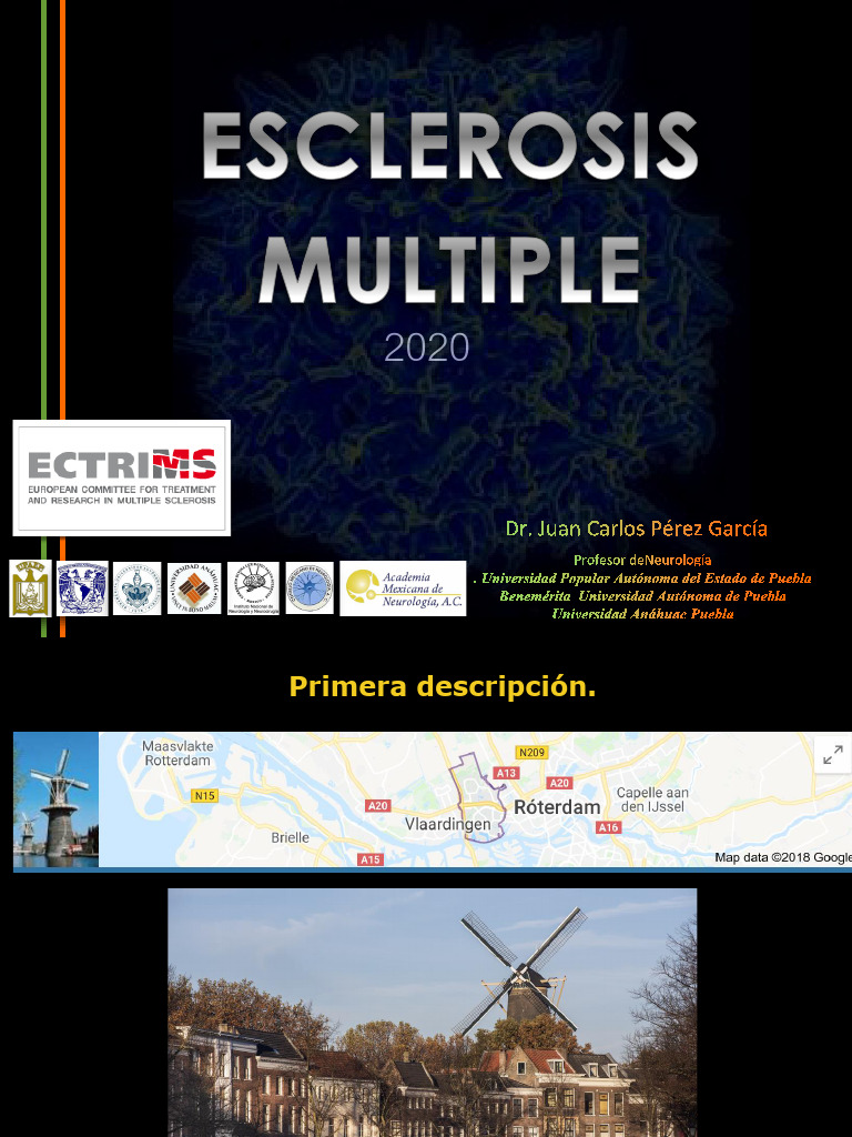 Esclerosis Múltiple | PDF | Esclerosis múltiple | Mielina