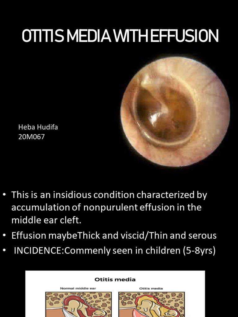 Otitis Media With Effusion | PDF | Otorhinolaryngology | Causes Of Death