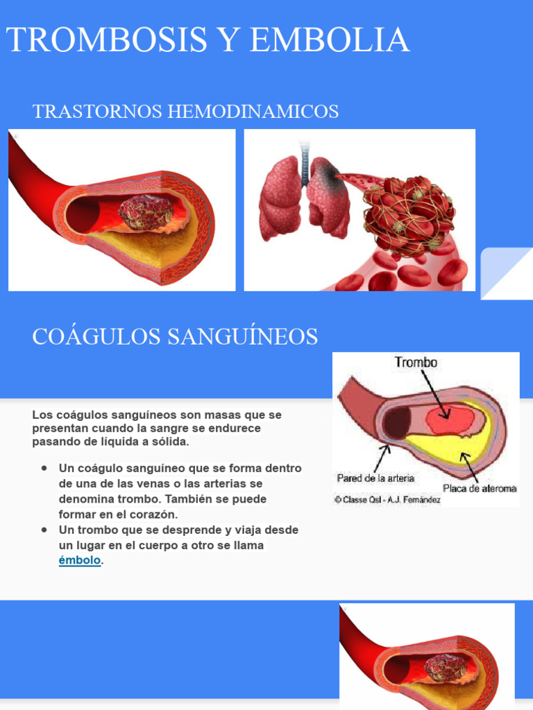 Trombosis y Embolia | PDF