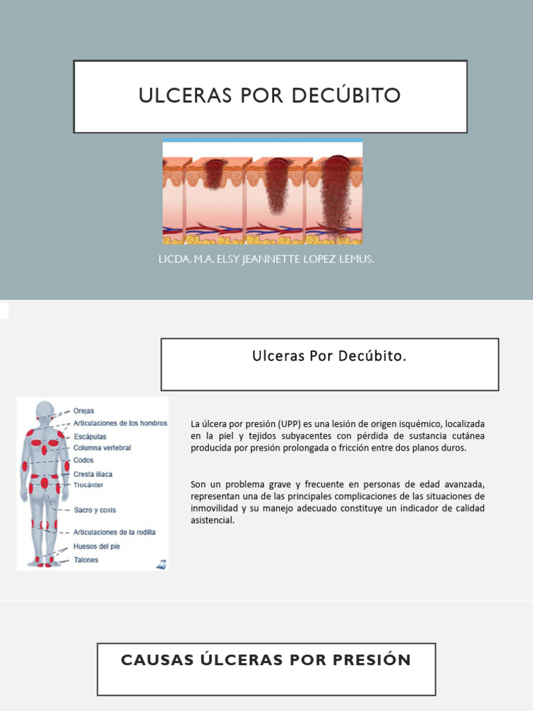 Ulceras Por Decubito | PDF
