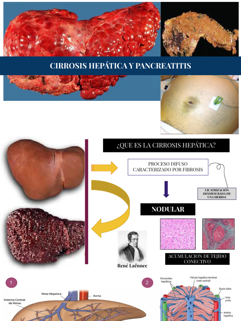 Cirrosis Hepatica y Pancreatitis | PDF