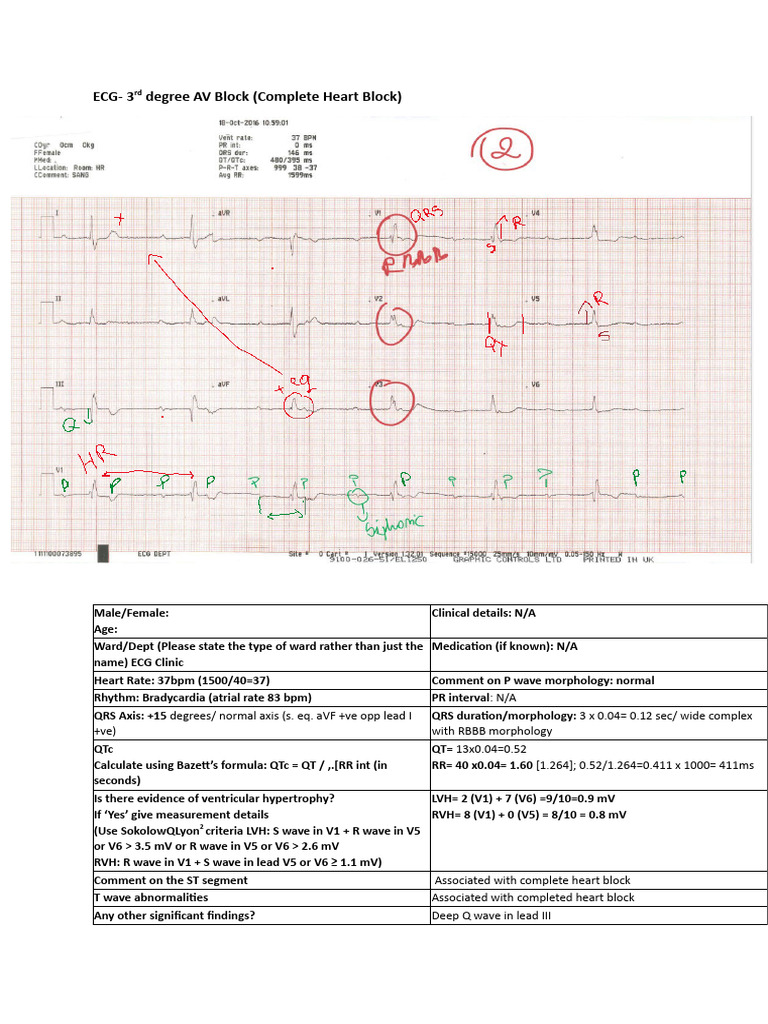 Complete Heart Block ECG Analysis | PDF | Electrocardiography ...
