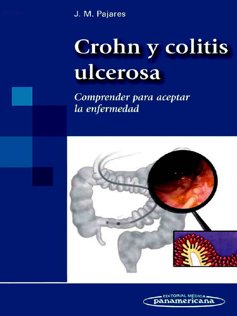 Crohn y Colitis Ulcerosa Comprender para Aceptar La Enfermedad Primera ...