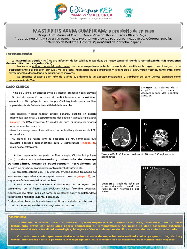 MASTOIDITIS AGUDA COMPLICADA: A Propósito de Un Caso: Introducción | PDF