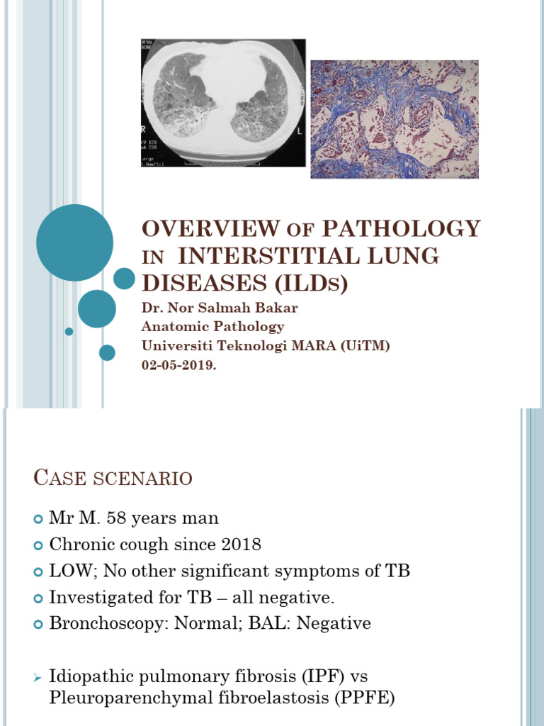 Pathology Interstitial Lung Diseases (Ild) : OF IN S | PDF