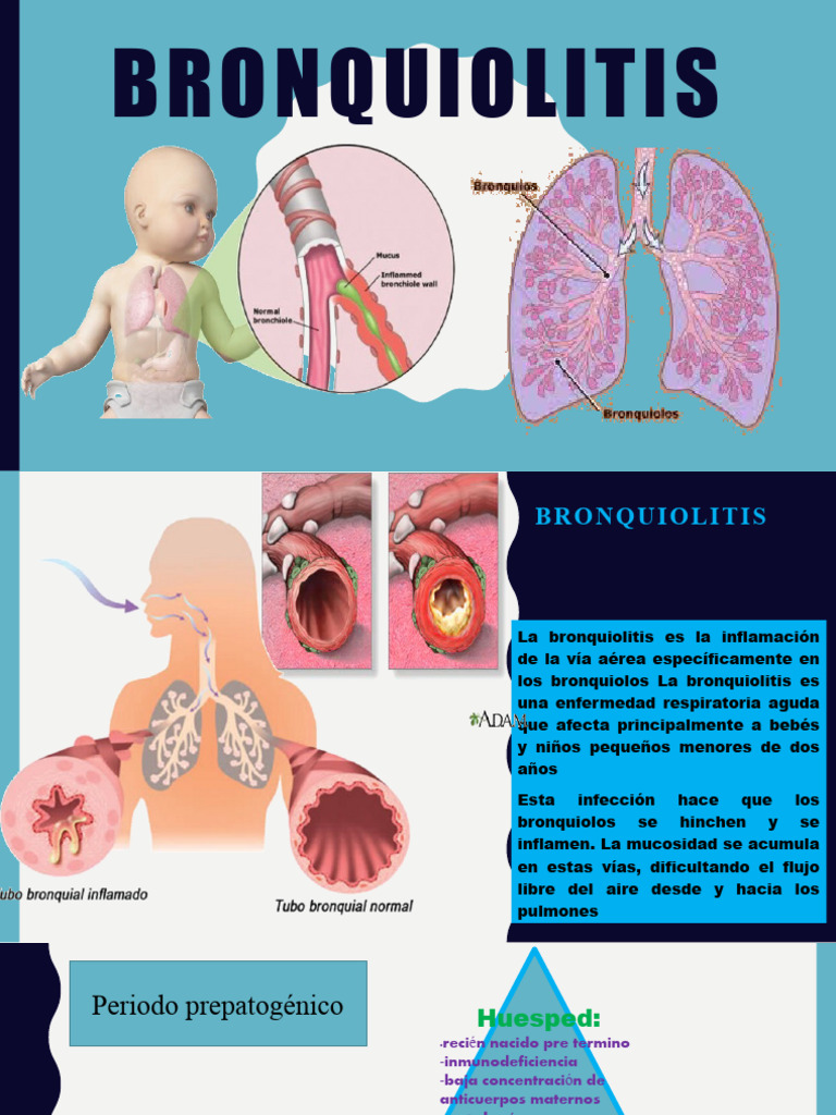 BRONQUIOLITIS | PDF | Ciencias de la Salud | Enfermedades y trastornos