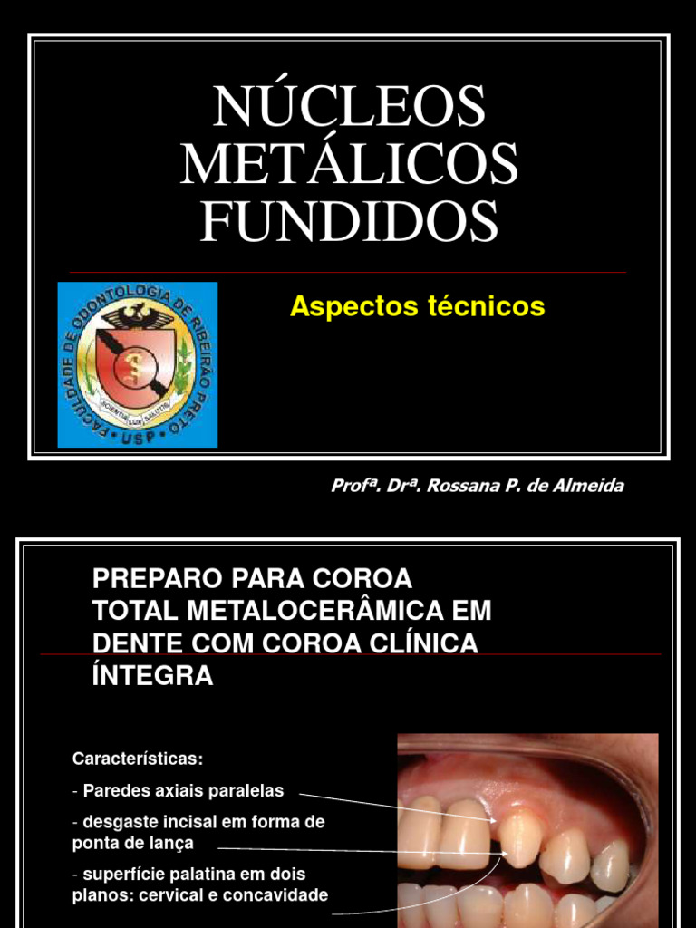 Núcleos Metálicos Fundidos Aspectos Técnicos 2020 | PDF | Prótese ...