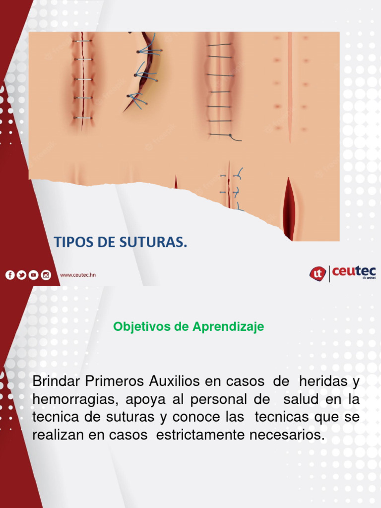 Presentación # 8 Tipo de Suturas | PDF | Herida | Sutura Quirúrgica