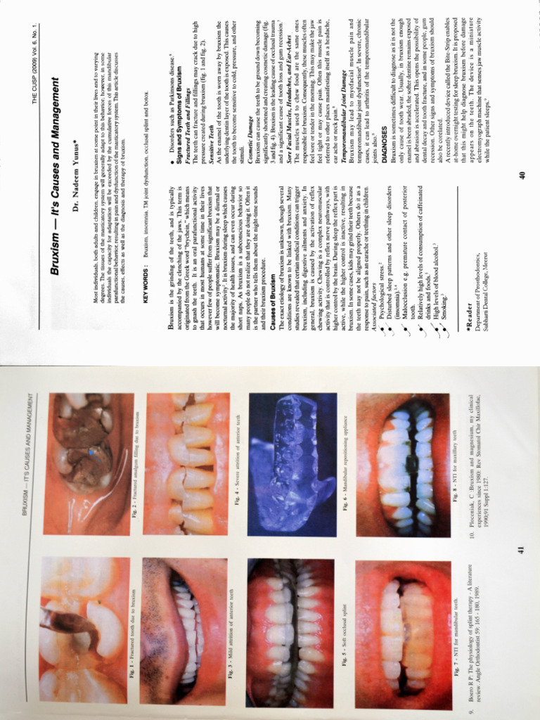Bruxism - Its Causes and Management | PDF