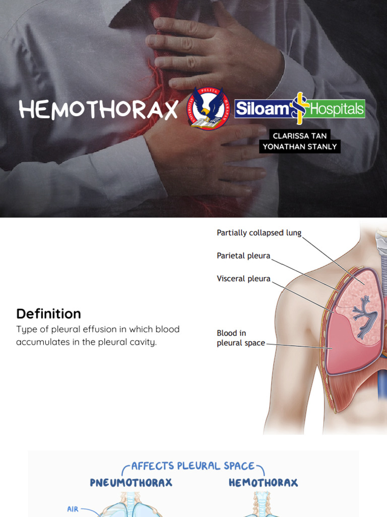 HEMOTHORAX | PDF