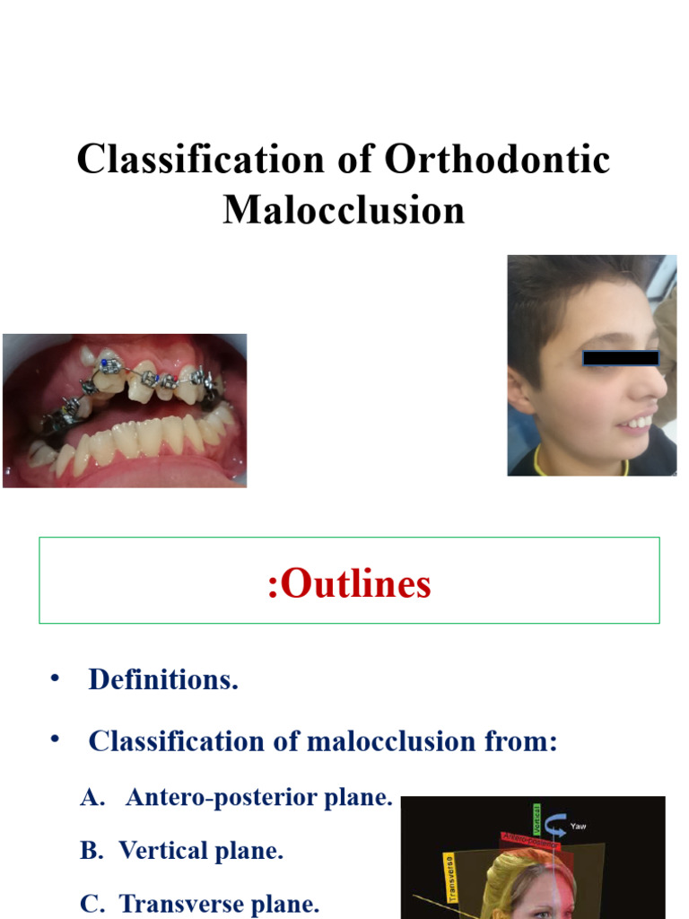 Classification of Malocclusion | PDF | Human Tooth | Animal Anatomy