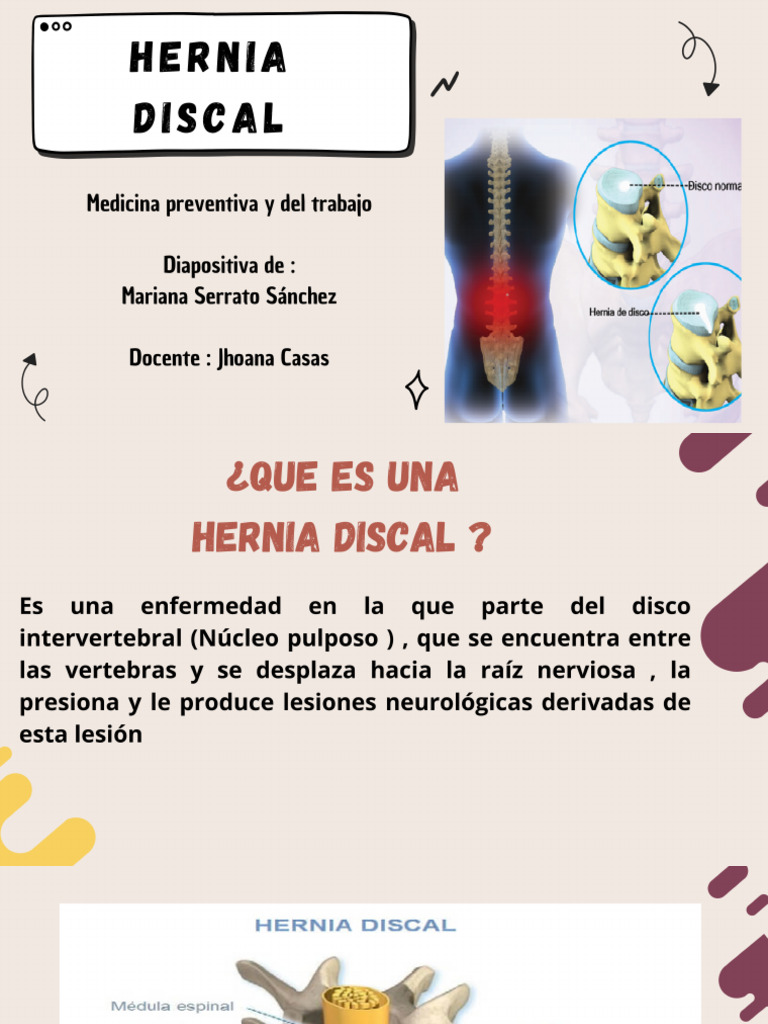 Hernia Discal | PDF