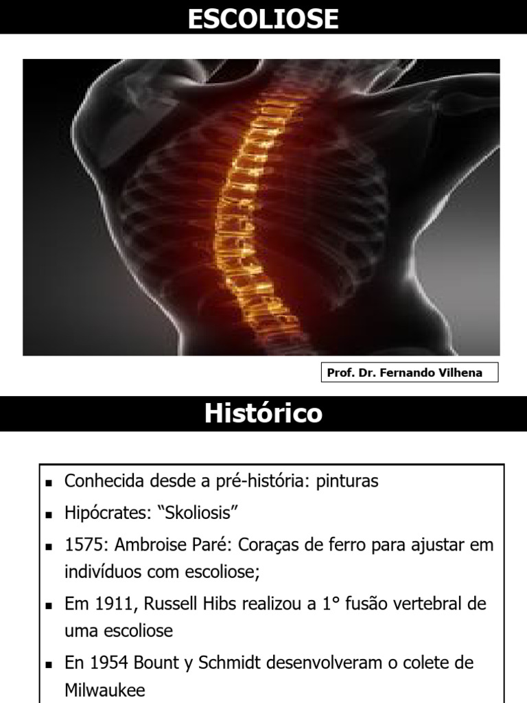 Escoliose | PDF | Escoliose | Medicina Clínica Escoliose | PDF | Escoliose | Medicina Clínica