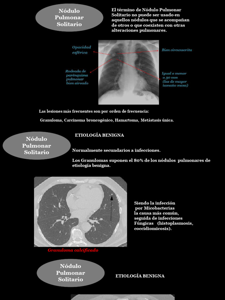Nódulo Pulmonar | PDF | Cáncer | Metástasis