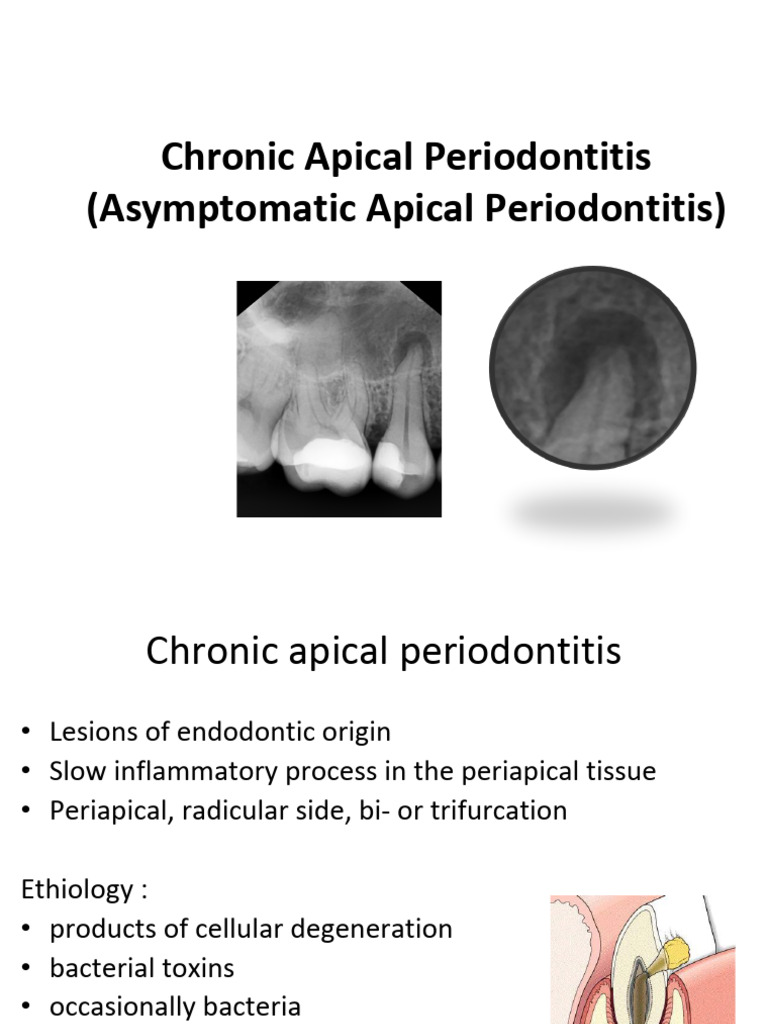 Lecture 5chronic Apical Periodontitis | PDF