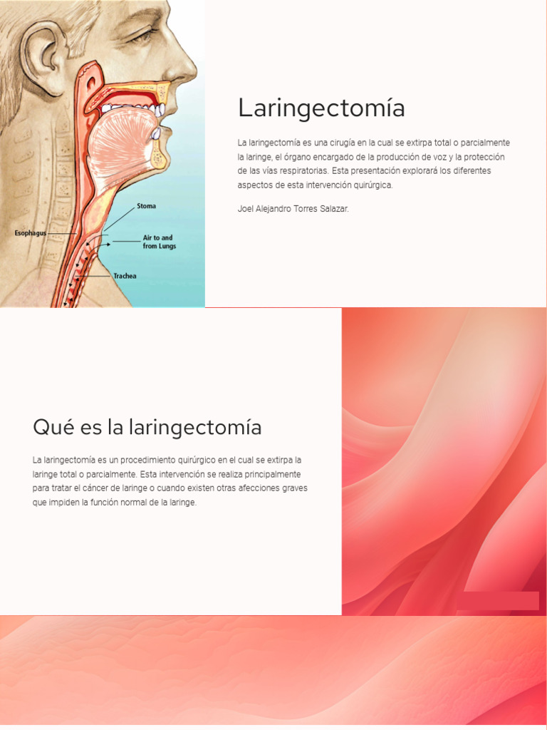 Laringectomia | PDF