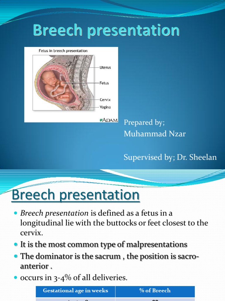Breech Presentation-Muhammad Nzar | PDF | Caesarean Section | Childbirth