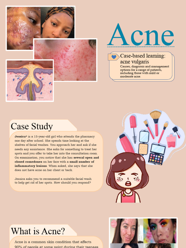 Acne Presentation | PDF | Clinical Medicine | Health Sciences