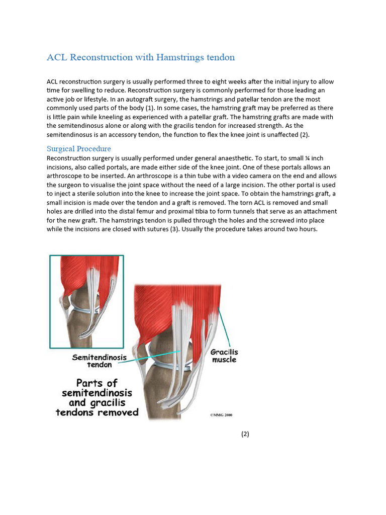 ACL Reconstruction With Hamstrings Tendon | PDF