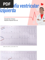 Índices Sokolow y Lewis en EKG | PDF