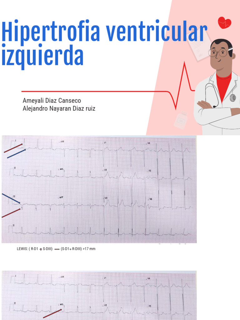 Hipertrofia Ventricular Izquierda | PDF