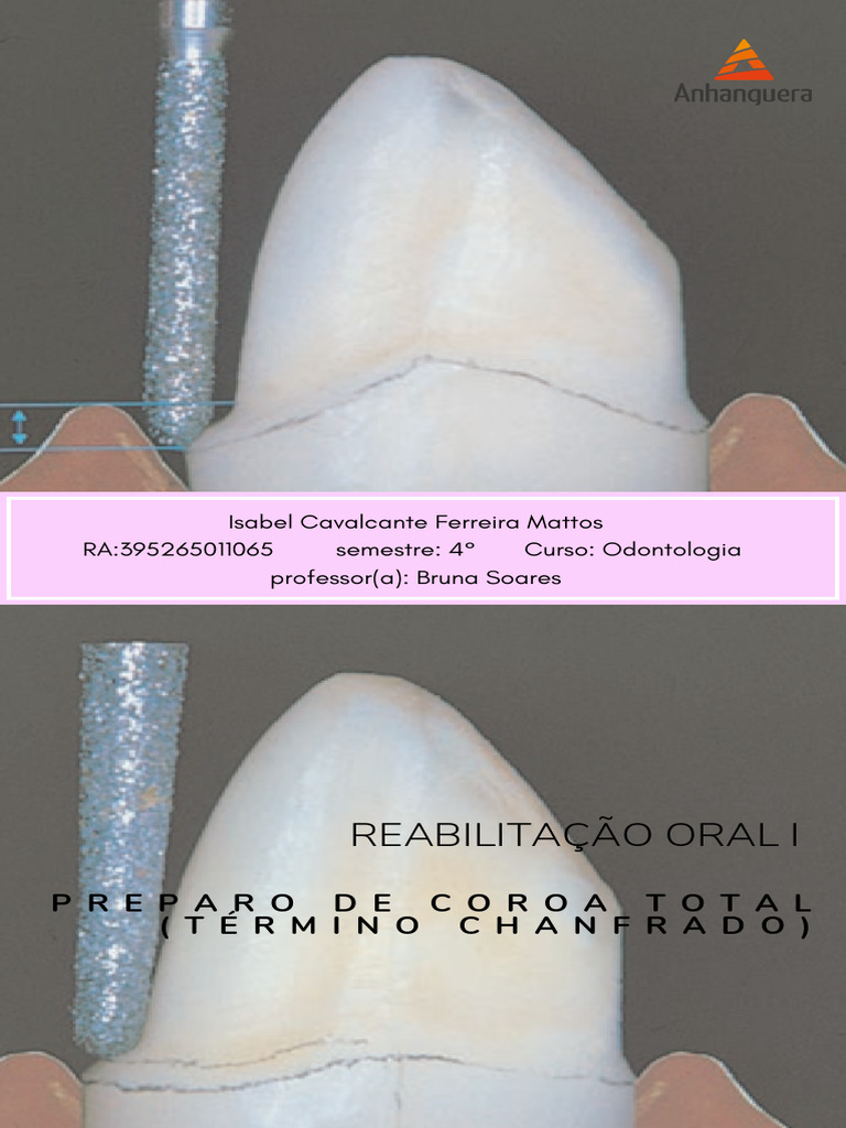 Preparo Com Término Chanfrado | PDF