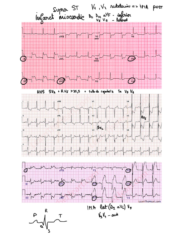 Ekg 1 | PDF