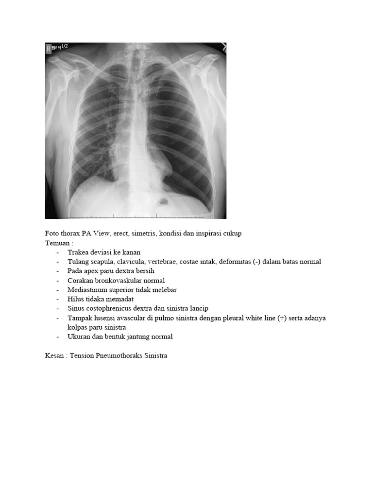 Temuan Sinus Costophrenicus Lancip | PDF | Perjalanan | Seni